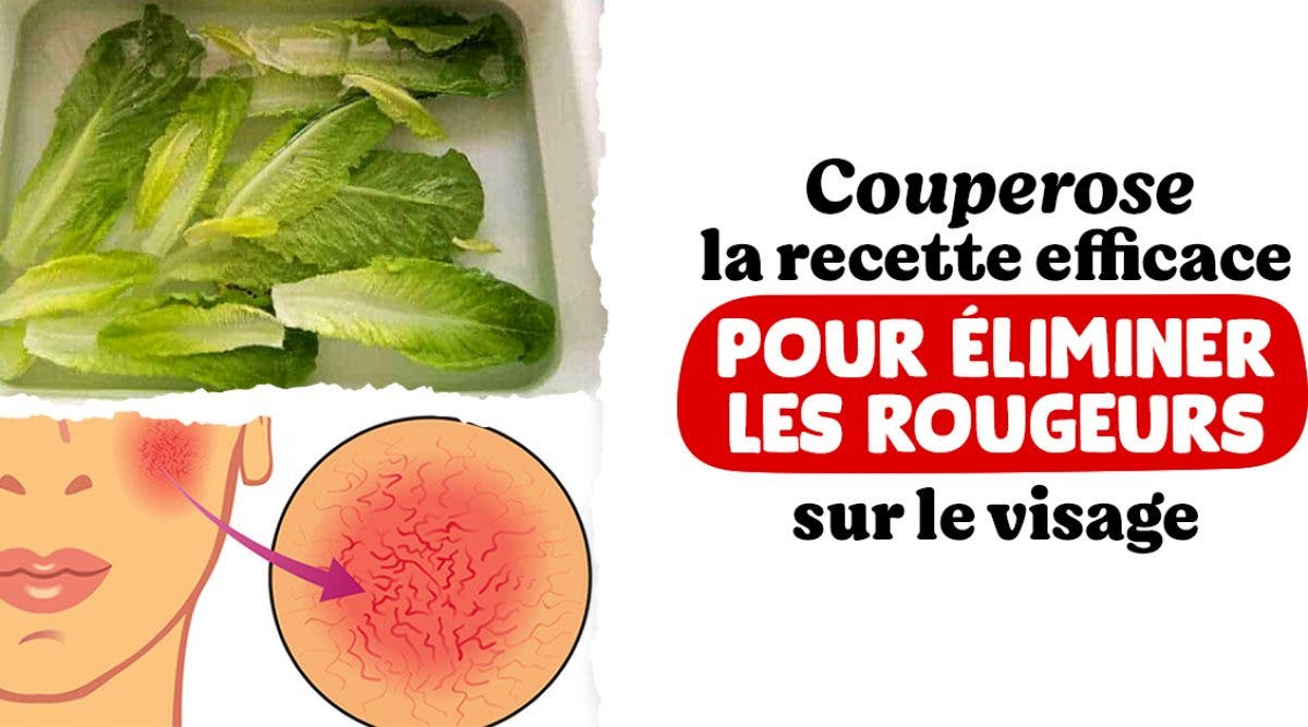 Couperose : la recette efficace pour éliminer les rougeurs sur le ...